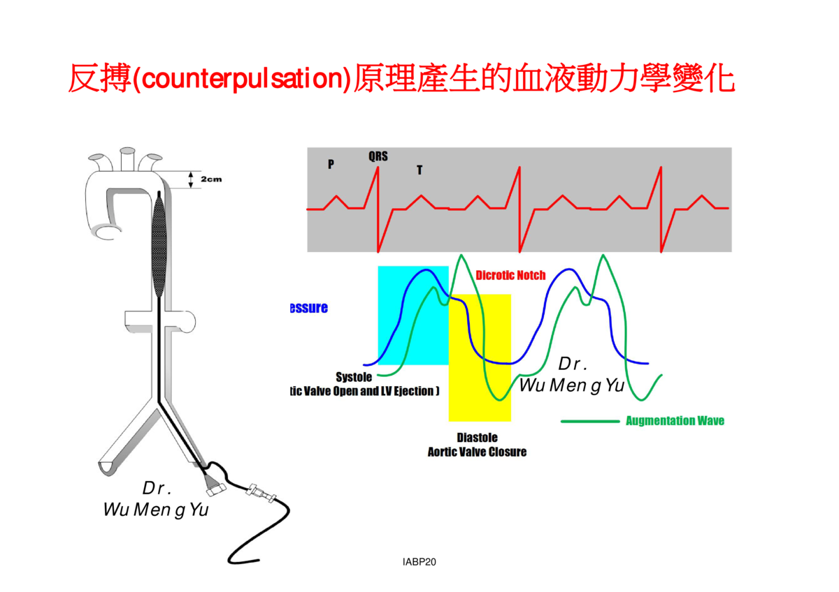 IABP introduction