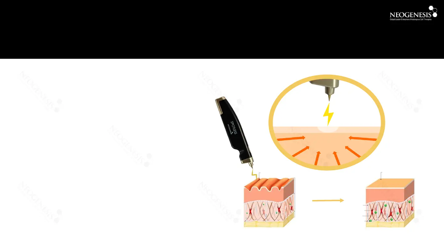 Neogenesis Spotless Device