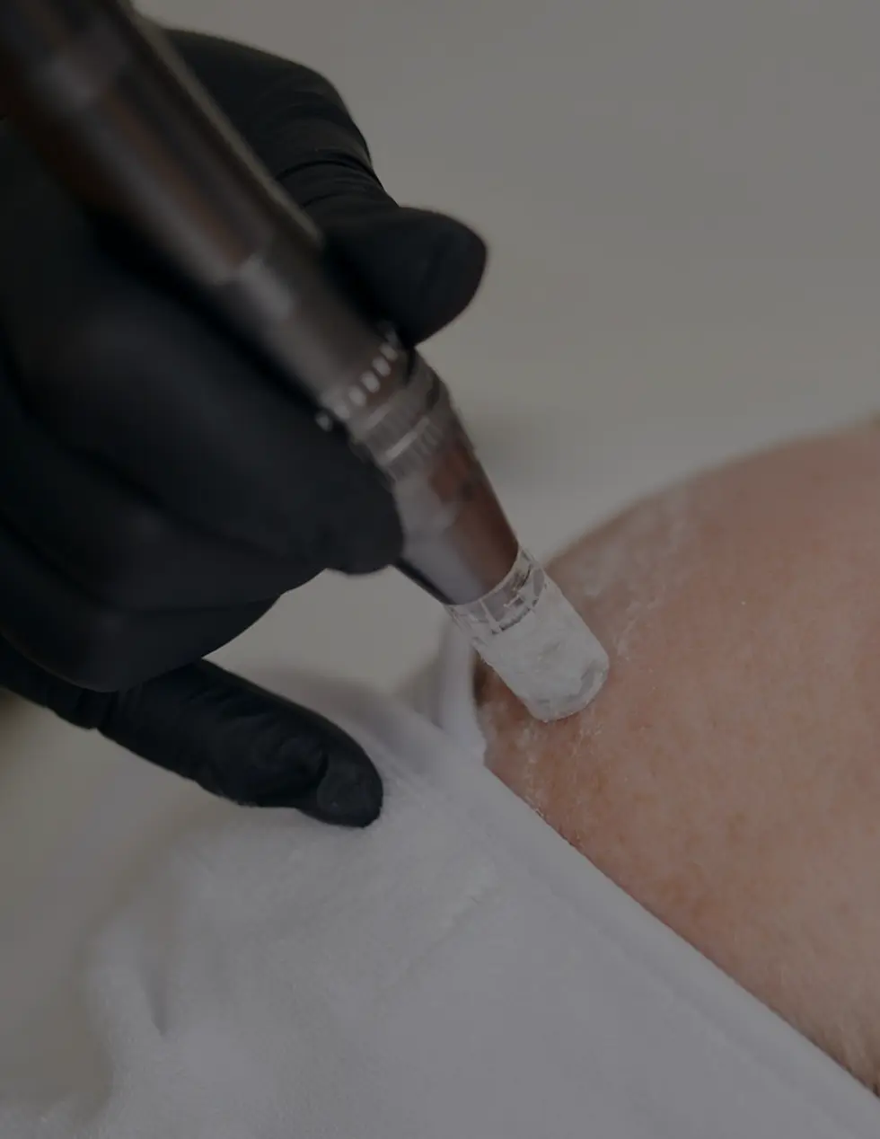 Nano-Needling: An In-Depth Guide for Estheticians